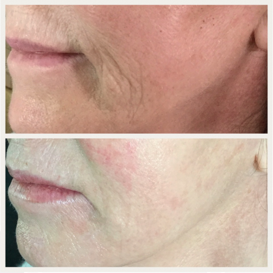 Plasma Skin Tightening | Diamond Medi Spa